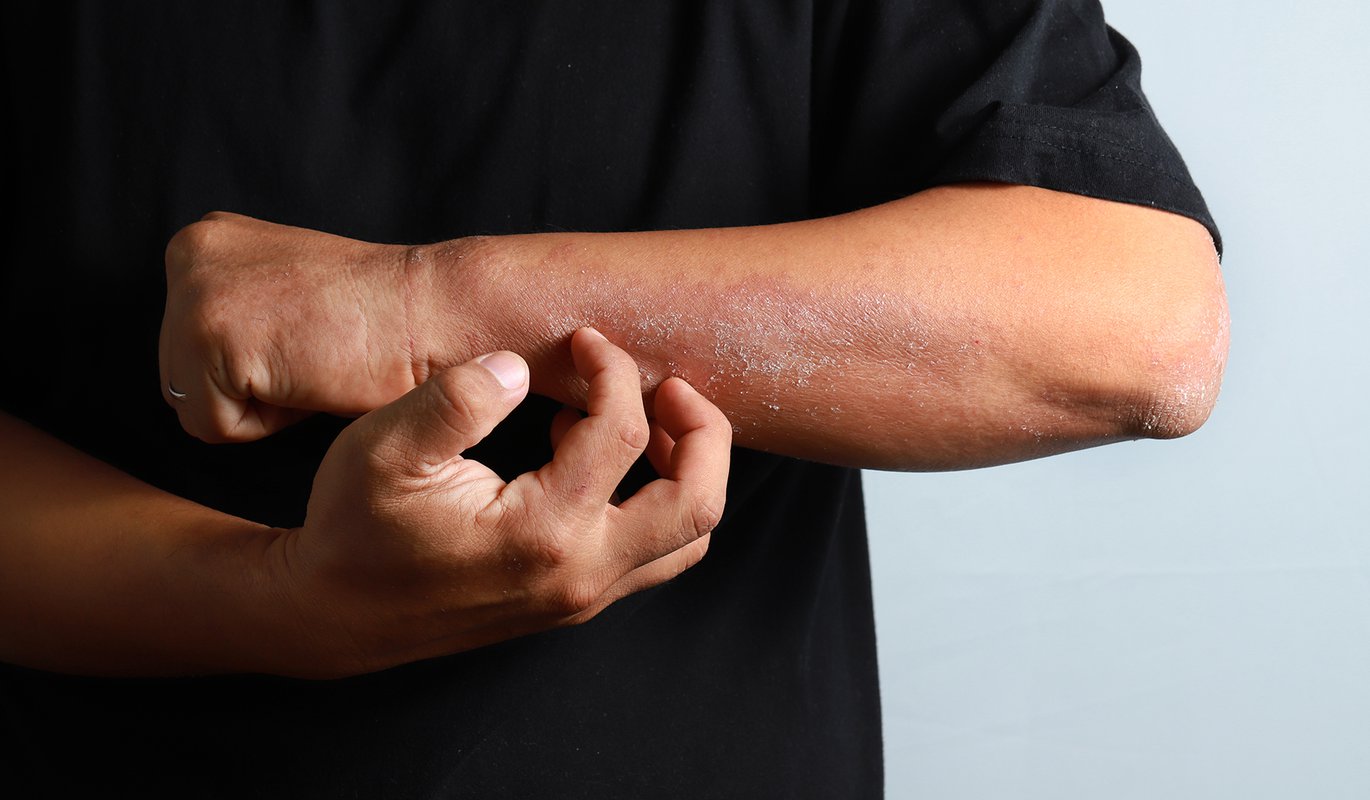 Why Do We Itch? | Blog: Experimental Musings | Science Museum of Virginia